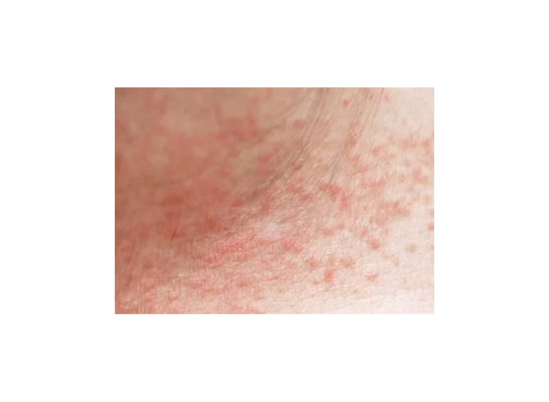 Sudamina: Qué es, Causas, Síntomas y Cómo Aliviarla Rápidamente - Farmamer